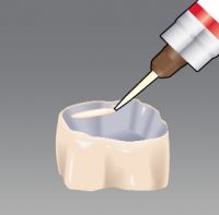 NexTemp® Temporary Cement