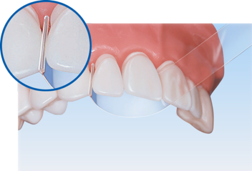 Premier Dental - Mylar Stop Strip