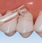 Premier Dental - Cure-Thru Clear Cervical Matrices