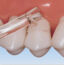 Premier Dental - Cure-Thru Clear Cervical Matrices