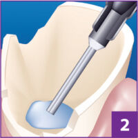 CompCore™ AF Dual-Cure Core Build-up Material