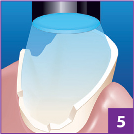 CompCore™ AF Dual-Cure Core Build-up Material