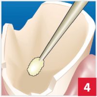 CompCore™ AF Dual-Cure Core Build-up Material