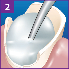 CompCore™ AF Dual-Cure Core Build-up Material