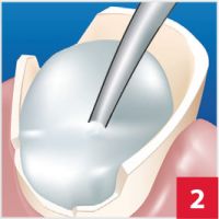 CompCore™ AF Dual-Cure Core Build-up Material
