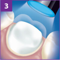 CompCore™ AF Dual-Cure Core Build-up Material