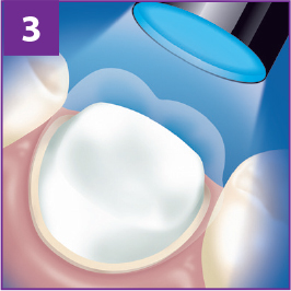 CompCore™ AF Dual-Cure Core Build-up Material