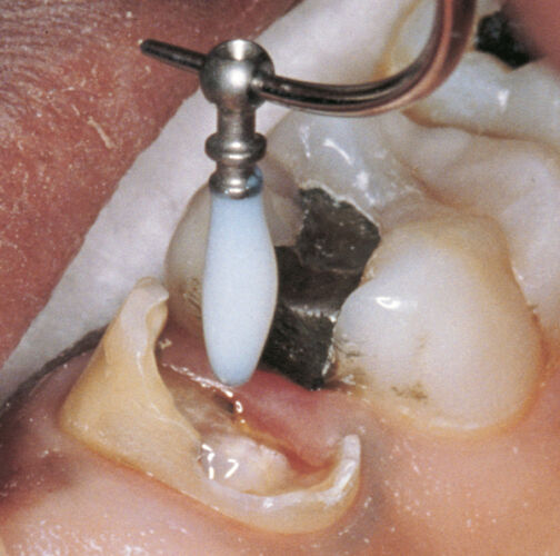 IntegraPost® - Metal Core Post for Restorative Dentistry