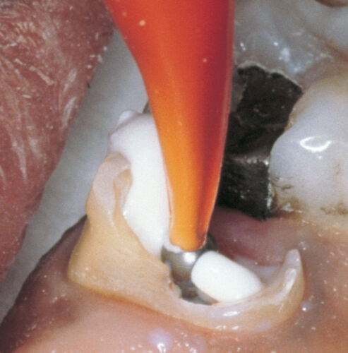 IntegraPost® - Metal Core Post for Restorative Dentistry