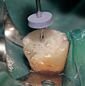 Premier Dental - RC-Prep® Chemo-mechanical Preparation