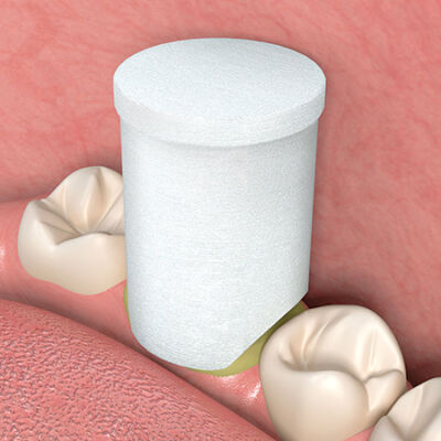 Premier Dental - Premier® Retraction Caps