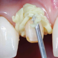 Traxodent® Hemostasis & Retraction Paste