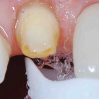 Traxodent® Hemostasis & Retraction Paste