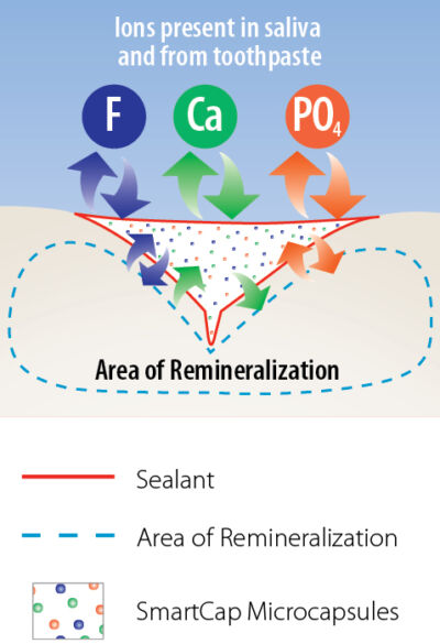 BioCoat® Pit & Fissure Sealant