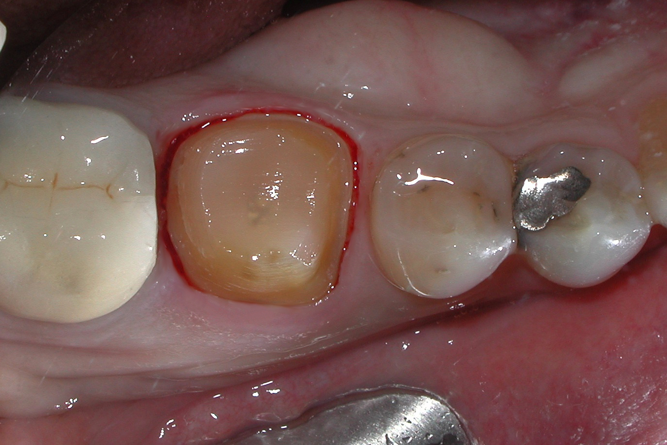 …Tissue Managment Is Indispendable by Jason H. Goodchild, DMD