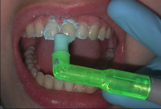 Premier Dental - Clinical Pearls – Coronal Polishing