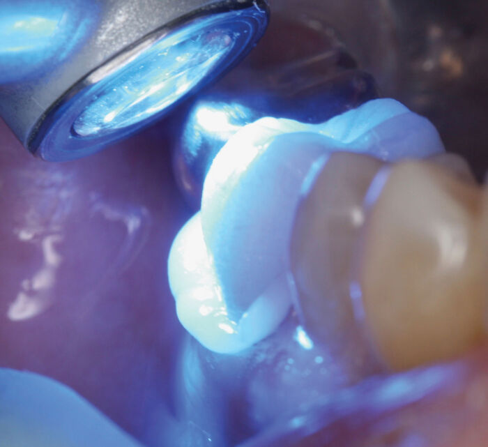 Premier Dental - ZR-Cem® Self-Adhesive Resin Cement