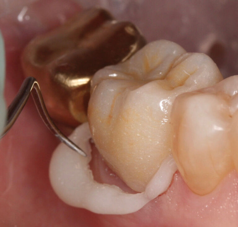 Premier Dental - ZR-Cem® Self-Adhesive Resin Cement