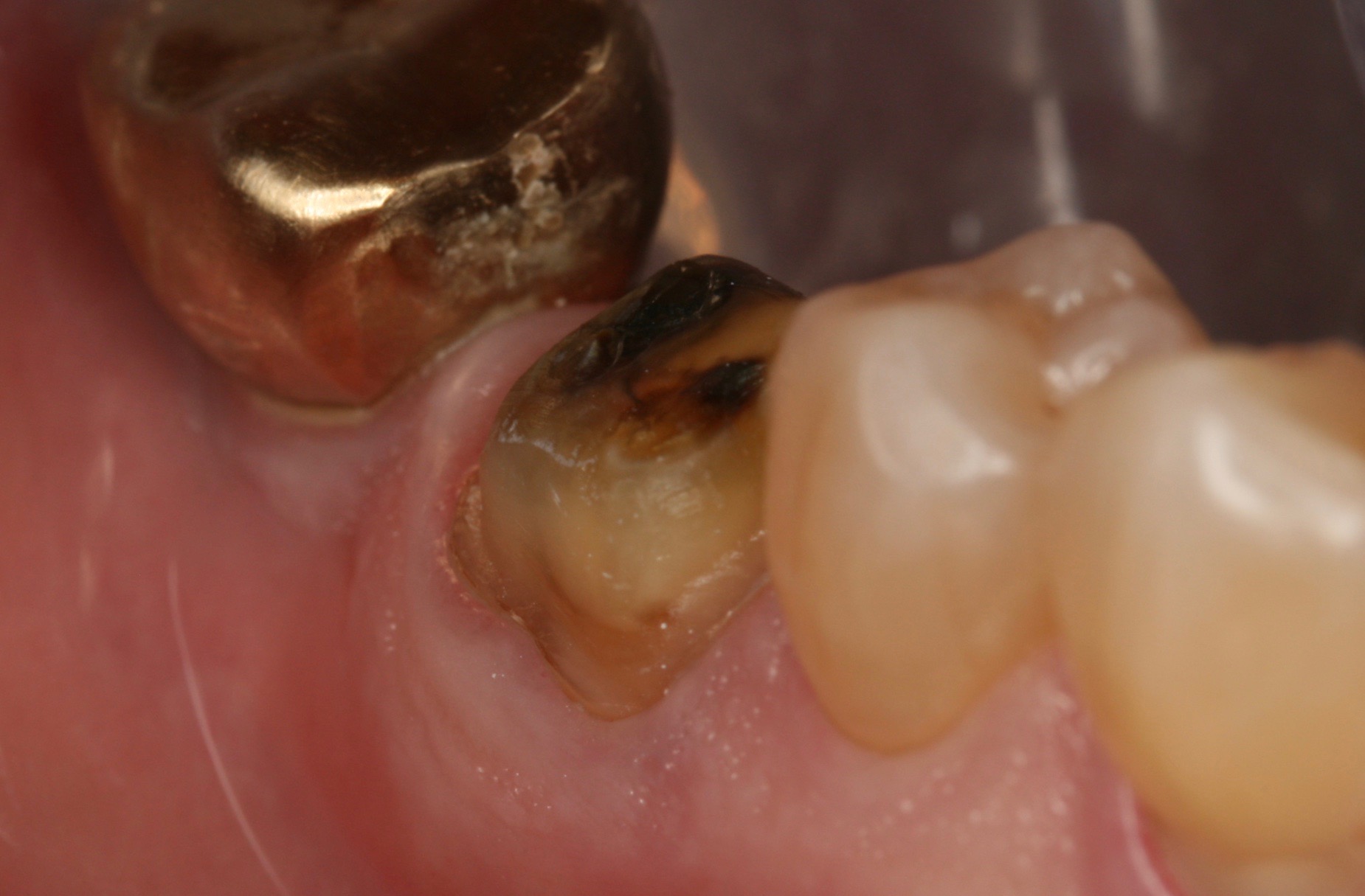 Premier Dental | An Easier and More Predictable Zirconia Cementation ...