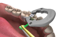 Premier Dental - Premier X5 Sectional Matrix System® Ring Universal