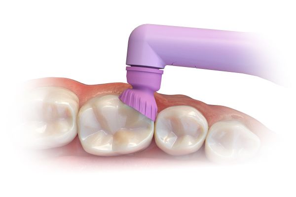 ProFlare® Articulating Disposable Prophy Angle