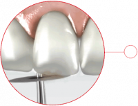 Premier Dental - VeneerNow™ Injectable Matrix System Kits