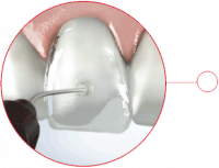 Premier Dental - VeneerNow™ Injectable Matrix System Kits