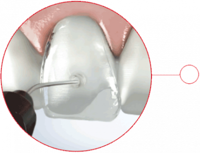 Premier Dental - VeneerNow™ Injectable Matrix System Kits