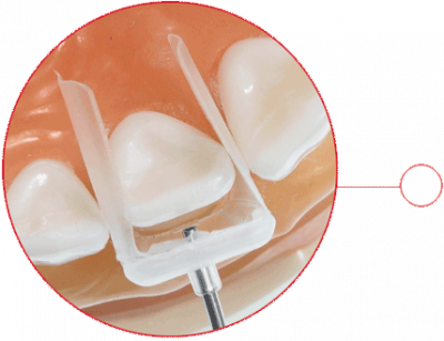 Premier Dental - VeneerNow™ Injectable Matrix System Kits