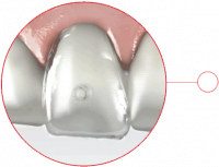 Premier Dental - VeneerNow™ Injectable Matrix System Kits