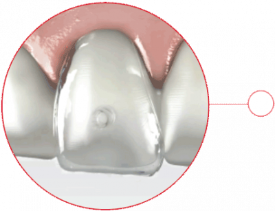 Premier Dental - VeneerNow™ Injectable Matrix System Kits